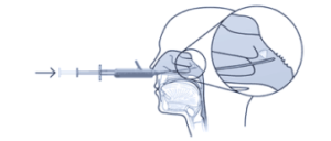 Tx360® Nasal Applicator - Tian Medical